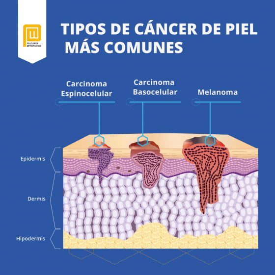 ¿qué Es El Cáncer De Piel Y Cómo Se Produce Policlínica Metropolitana